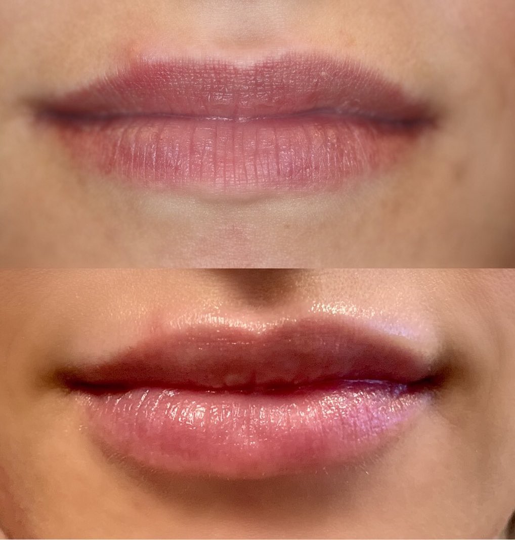 Lip Injections - The Laser and Skin Surgery Center of Indiana